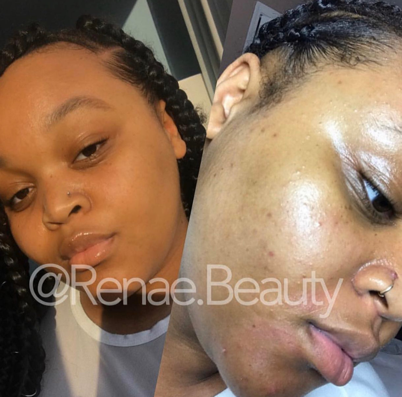 Hyperpigmentation/Scarring – Renae Beauty